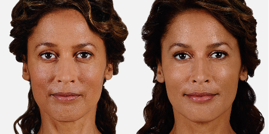 Before & After