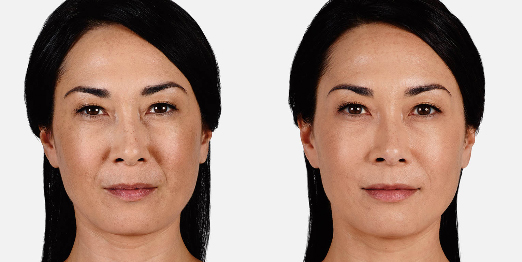 Before & After
